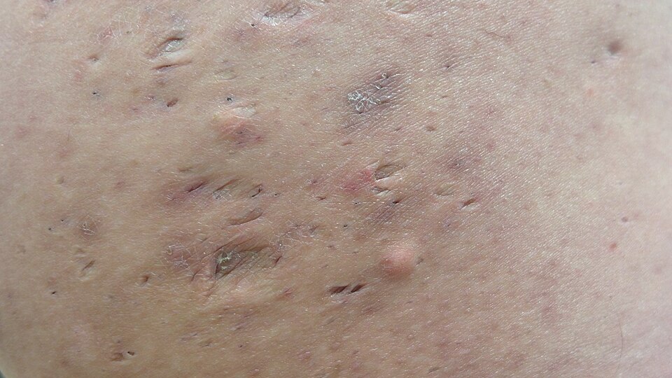Acne inversa, il farmaco sarà rimborsato dal SSN